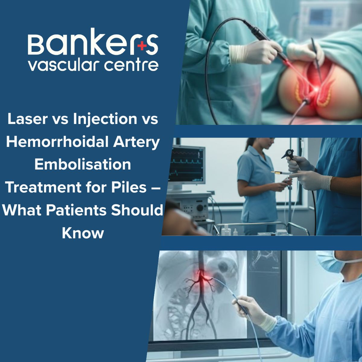 Laser vs Injection vs Hemorrhoidal Artery Embolisation Treatment for Piles – What Patients ...